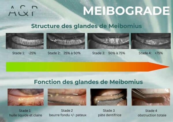 Evaluer les glandes de Meibomius - Emgidi